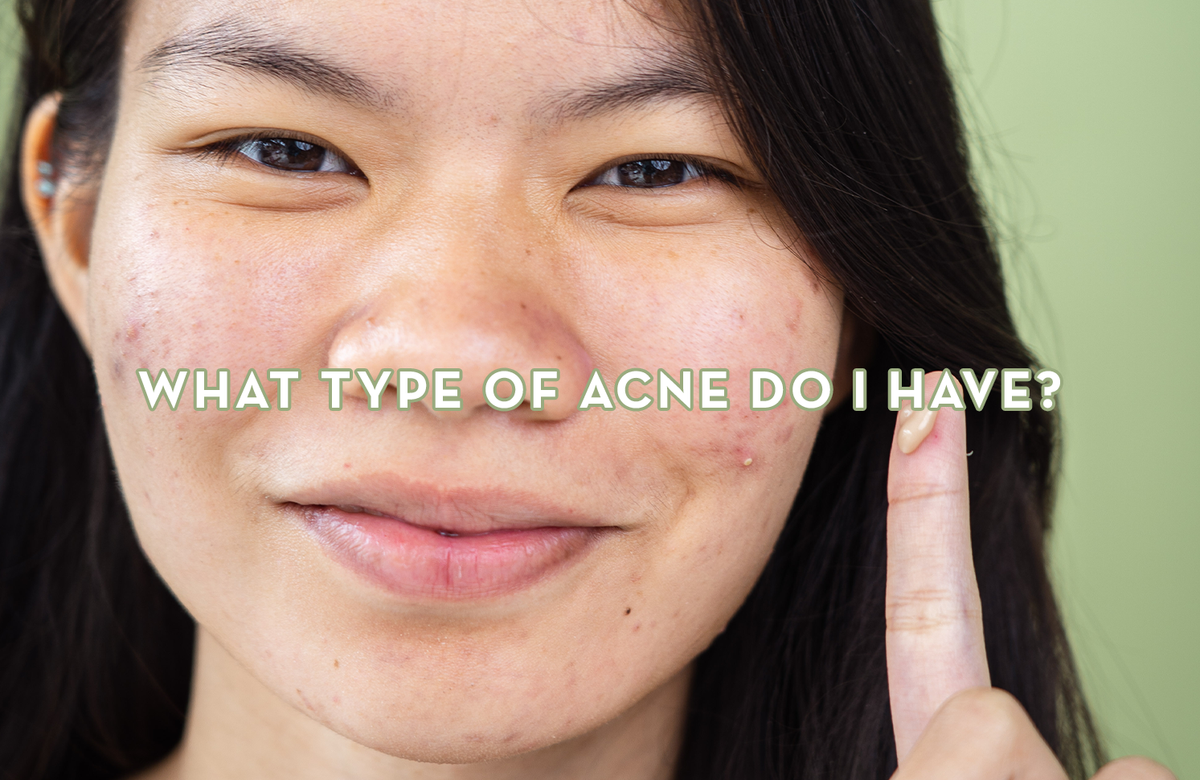 What Type Of Acne Do I Have?